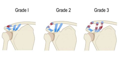 AC-Gelenksluxation behandeln – Prof. Dr. Martetschläger